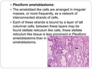 Ameloblastoma | PPTX