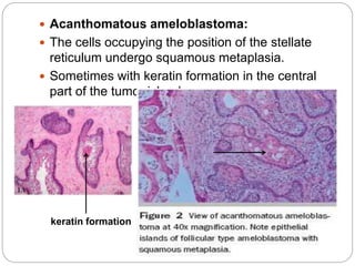 Plexiform Ameloblastoma Histology