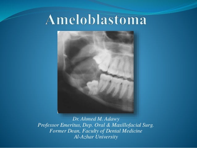 Ameloblastoma