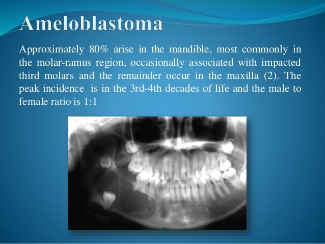 Ameloblastoma