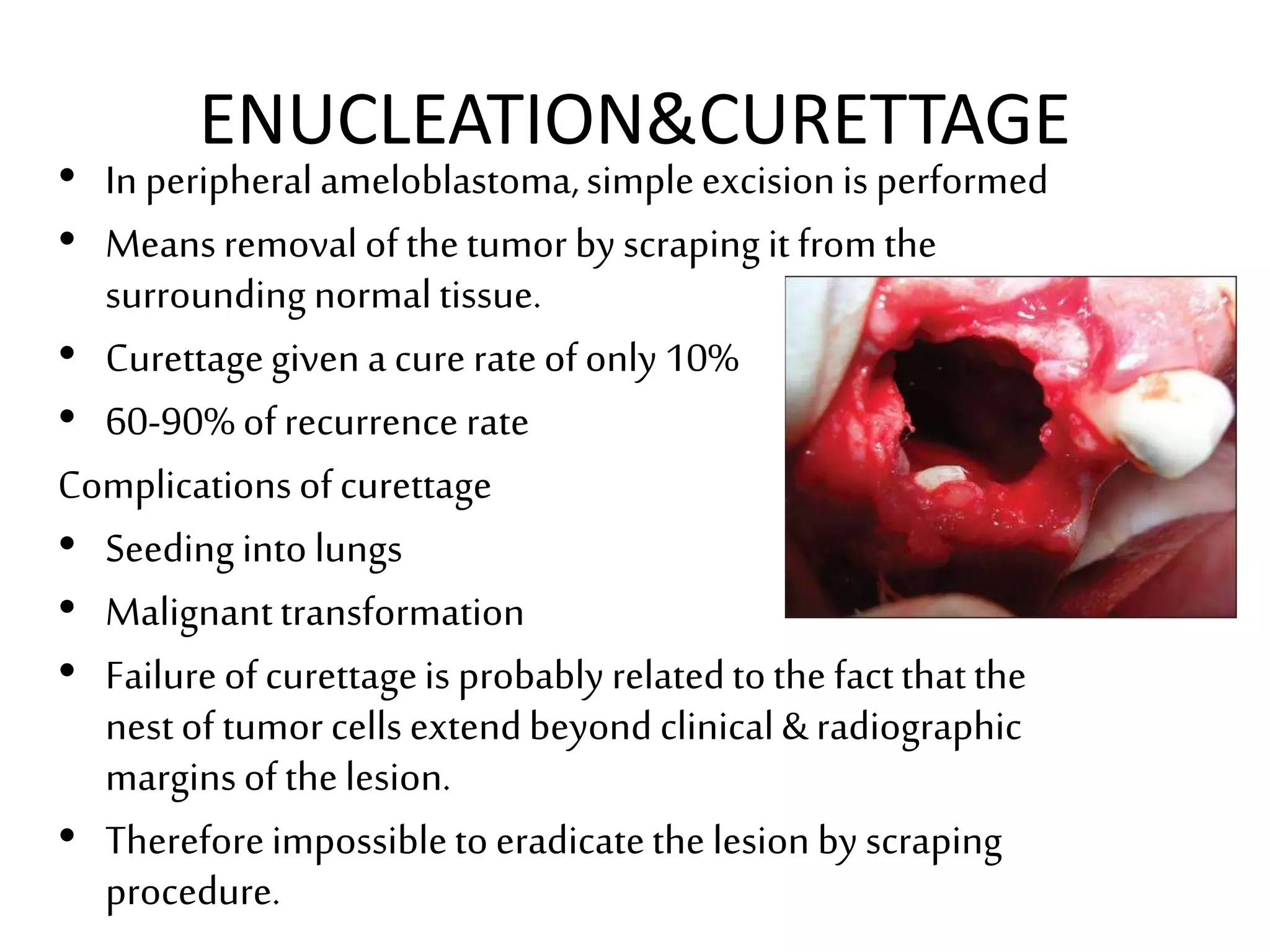 Ameloblastoma | PPTX