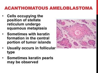Plexiform Ameloblastoma Histology