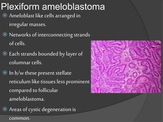 Plexiform Ameloblastoma Histology