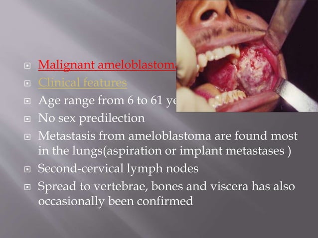 Ameloblastoma | PPTX