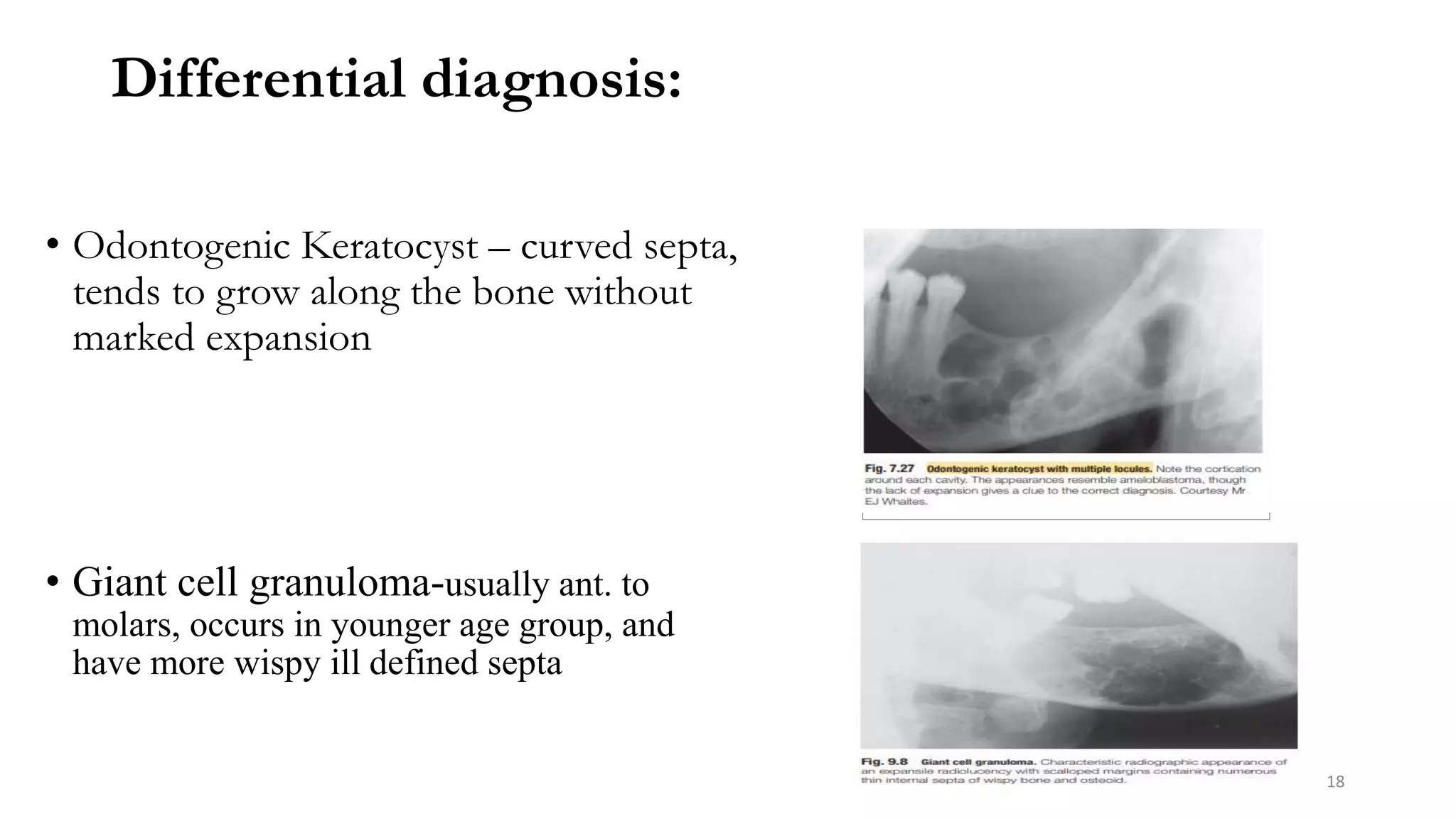 Ameloblastoma | PPTX