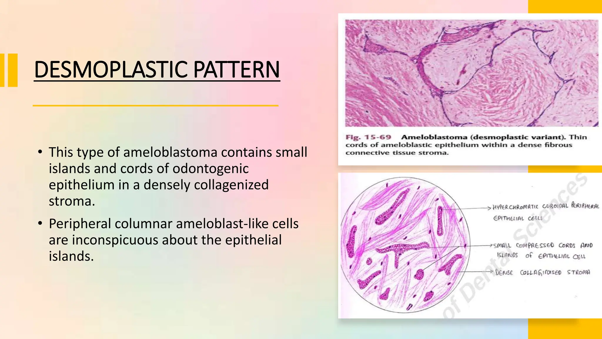 "Ameloblastoma" Odontogenic tumor Oral Pathology | PPTX