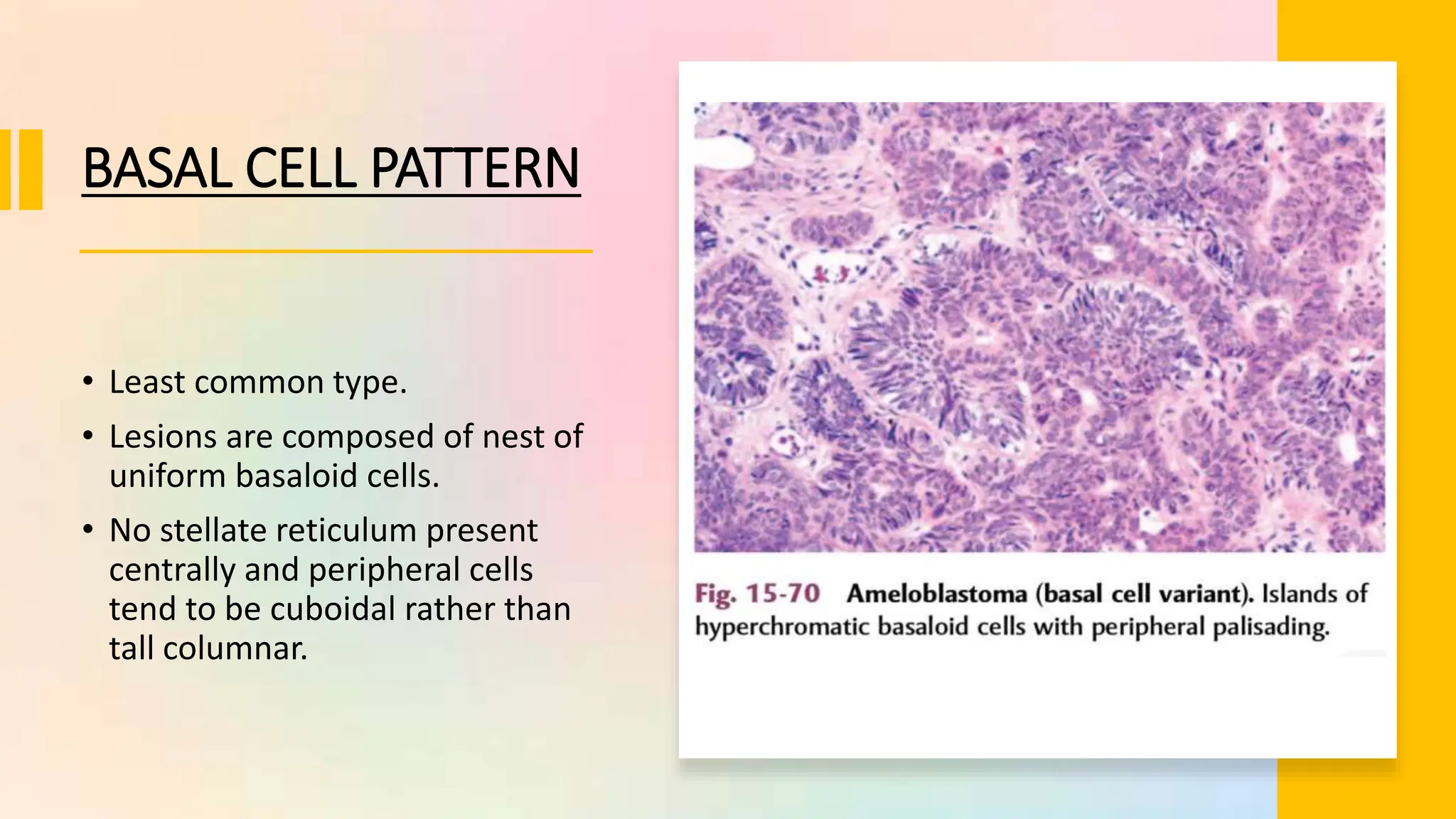 "Ameloblastoma" Odontogenic tumor Oral Pathology | PPTX