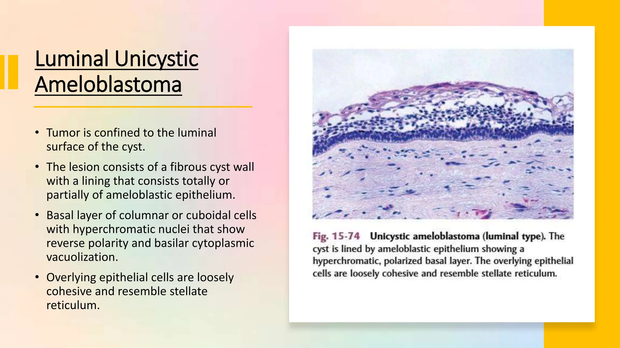 "Ameloblastoma" Odontogenic tumor Oral Pathology | PPTX