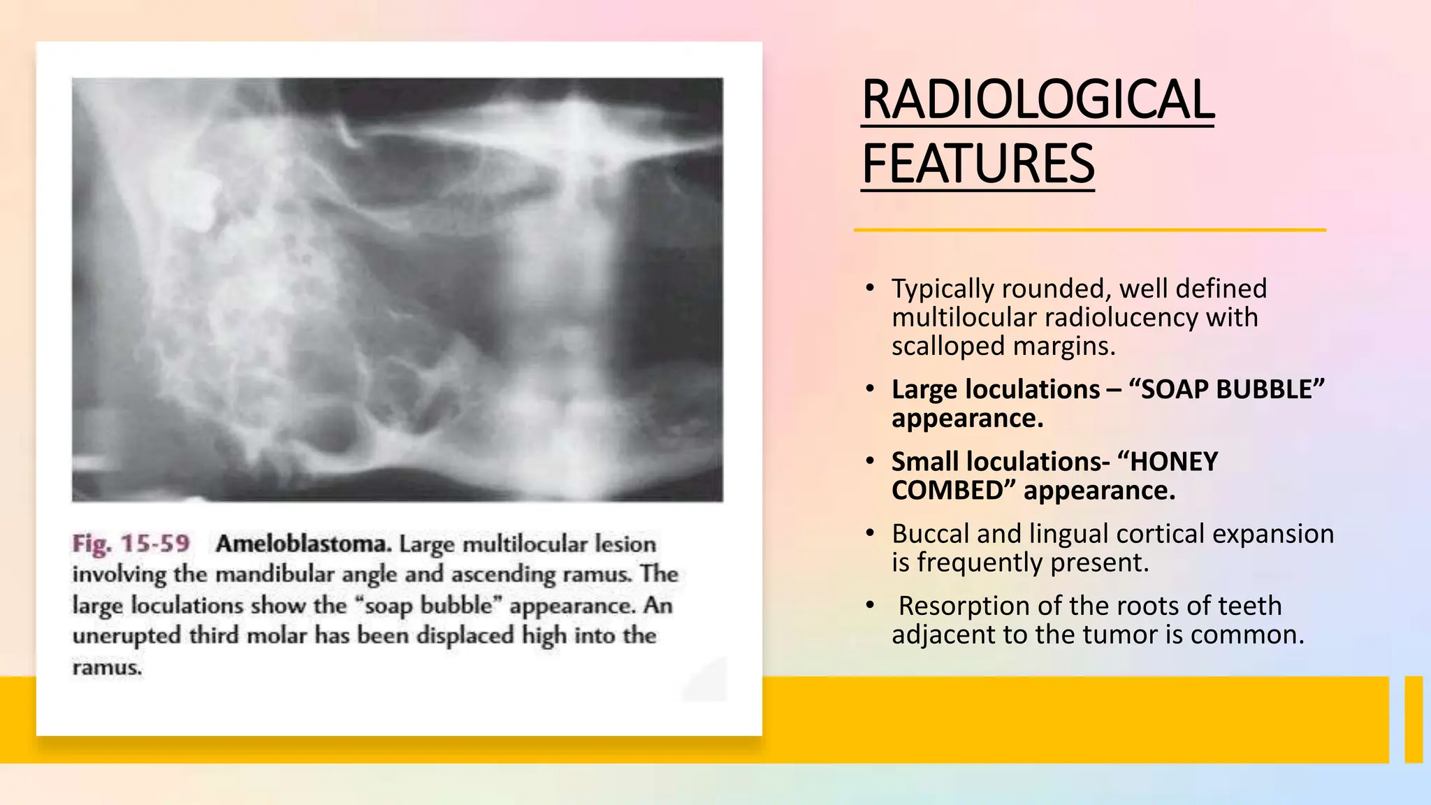 "Ameloblastoma" Odontogenic tumor Oral Pathology | PPTX