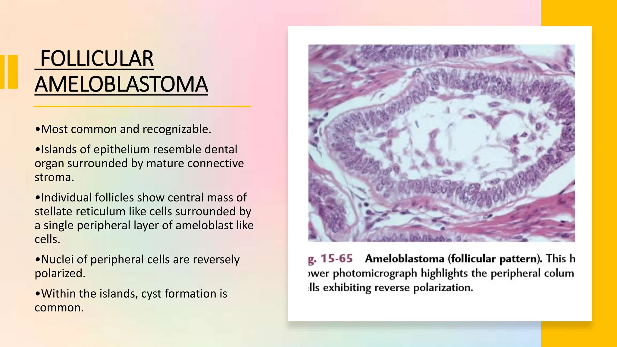 "Ameloblastoma" Odontogenic tumor Oral Pathology | PPTX