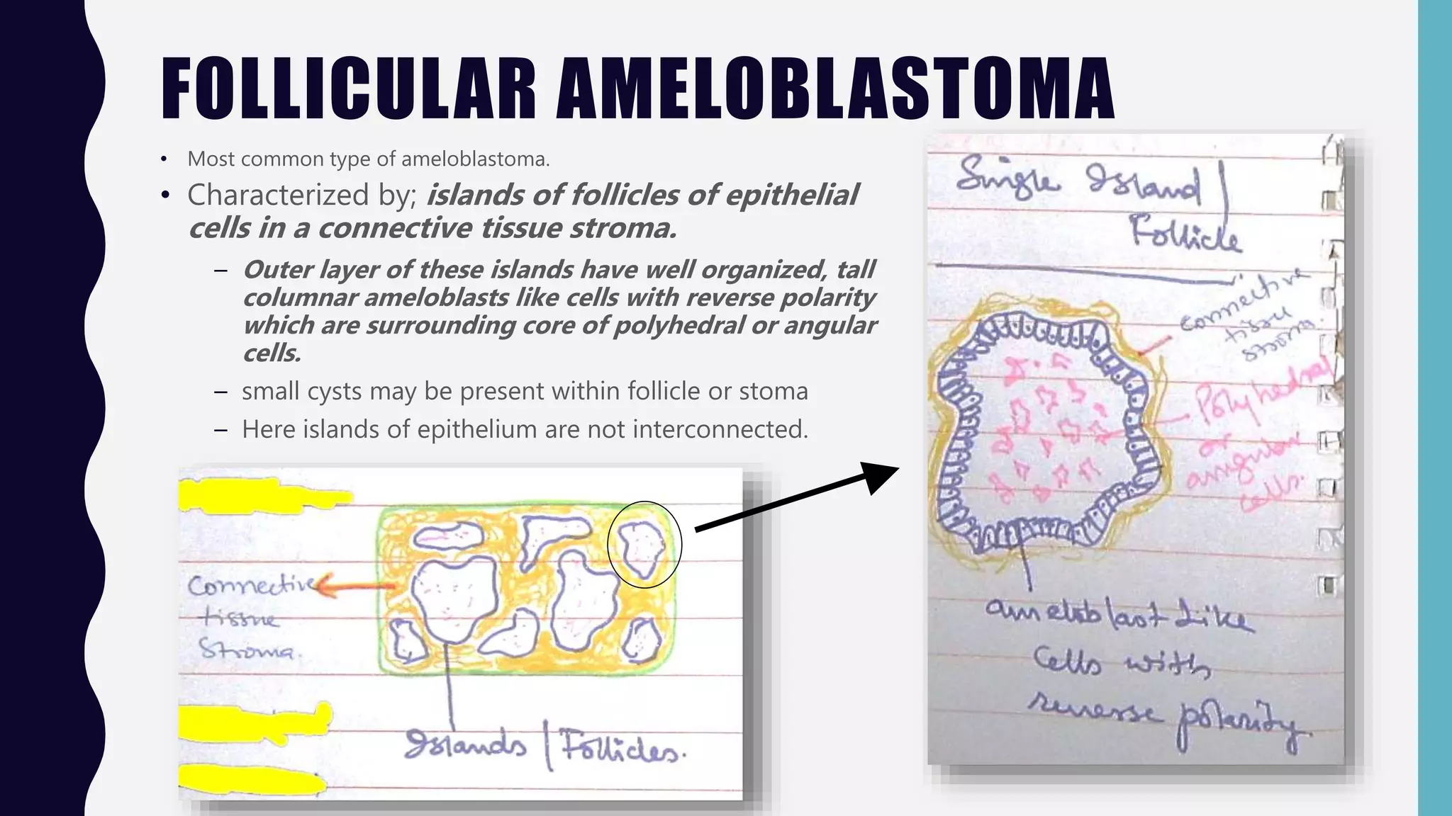 Ameloblastoma (Odontogenic Tumor) Oral Pathology | PPTX