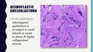 Desmoplastic Ameloblastoma Histology