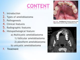 AMELOBLASTOMA [op].pptx