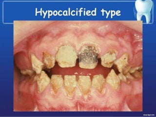 Amelogenesis Imperfecta Hypocalcified