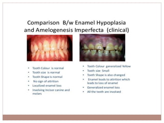 Amelogenesis Imperfecta Vs Dentinogenesis Imperfecta