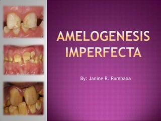 Amelogenesis Imperfecta