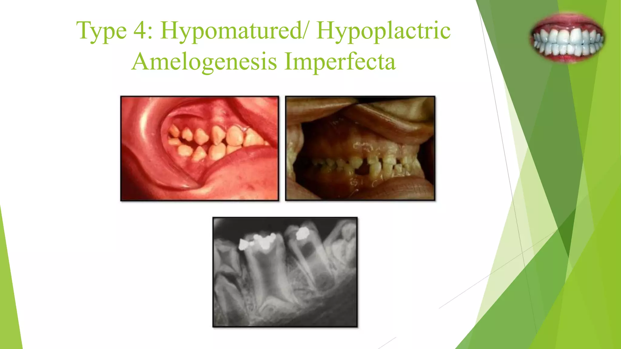 Amelogenesis imperfecta | PPTX