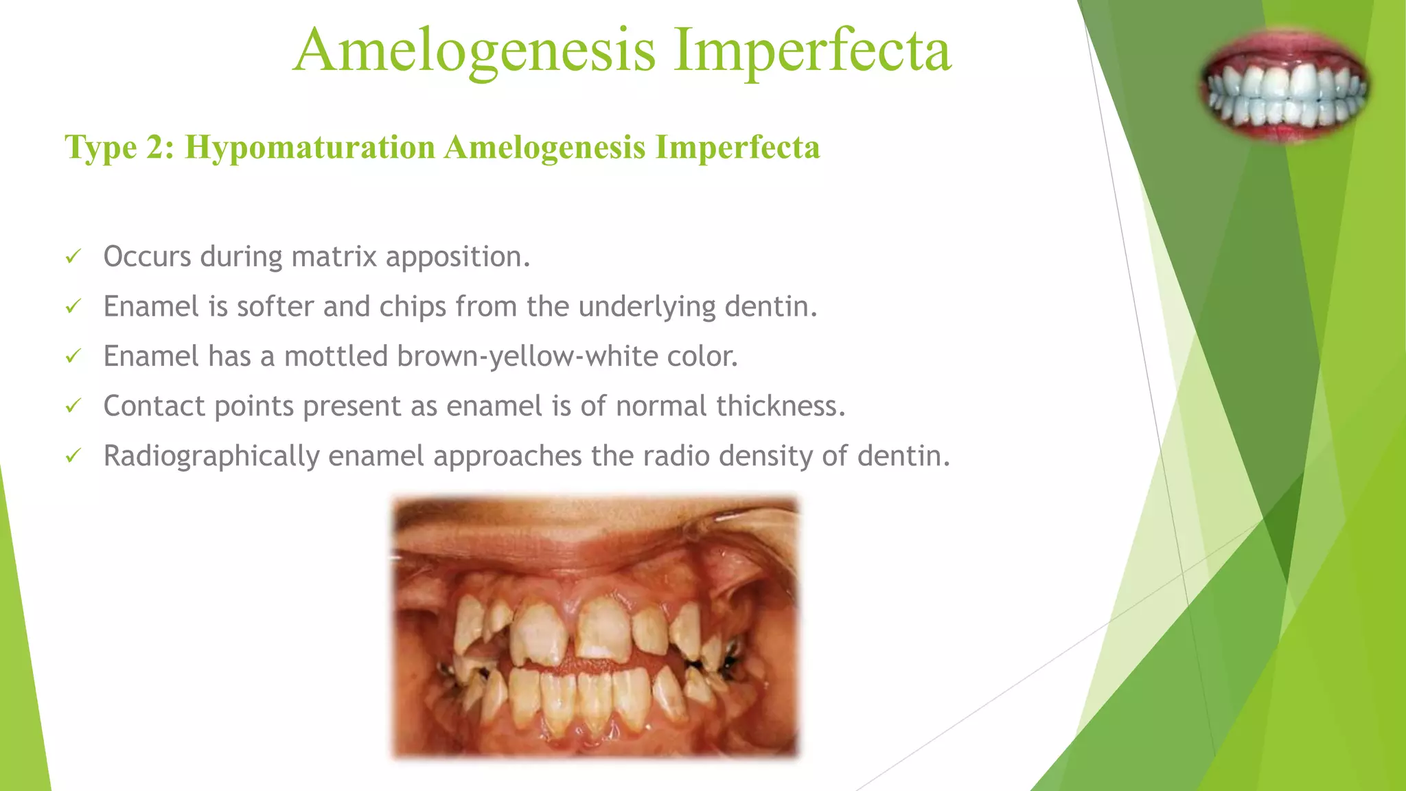 Amelogenesis imperfecta | PPTX