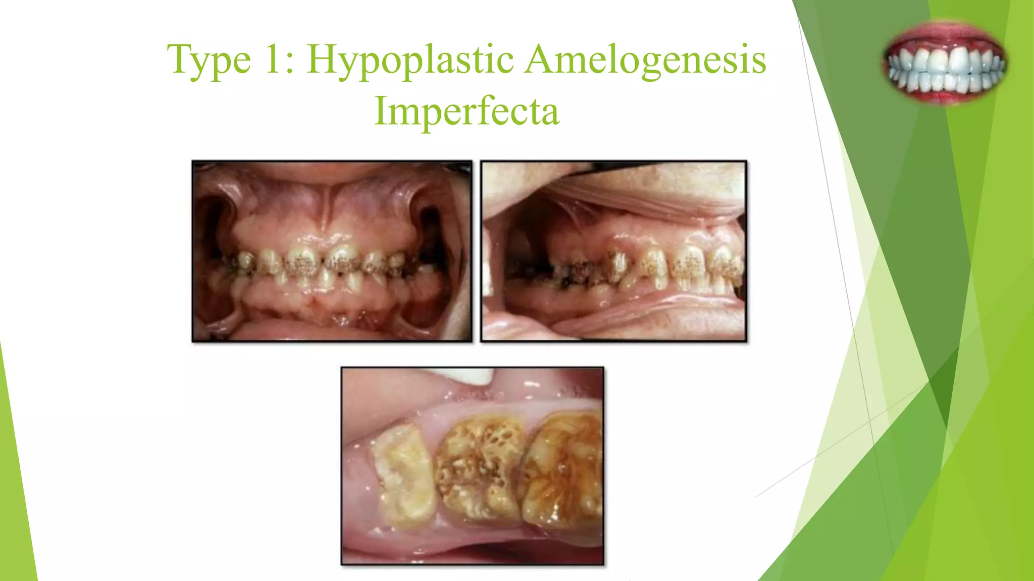 Amelogenesis imperfecta | PPTX