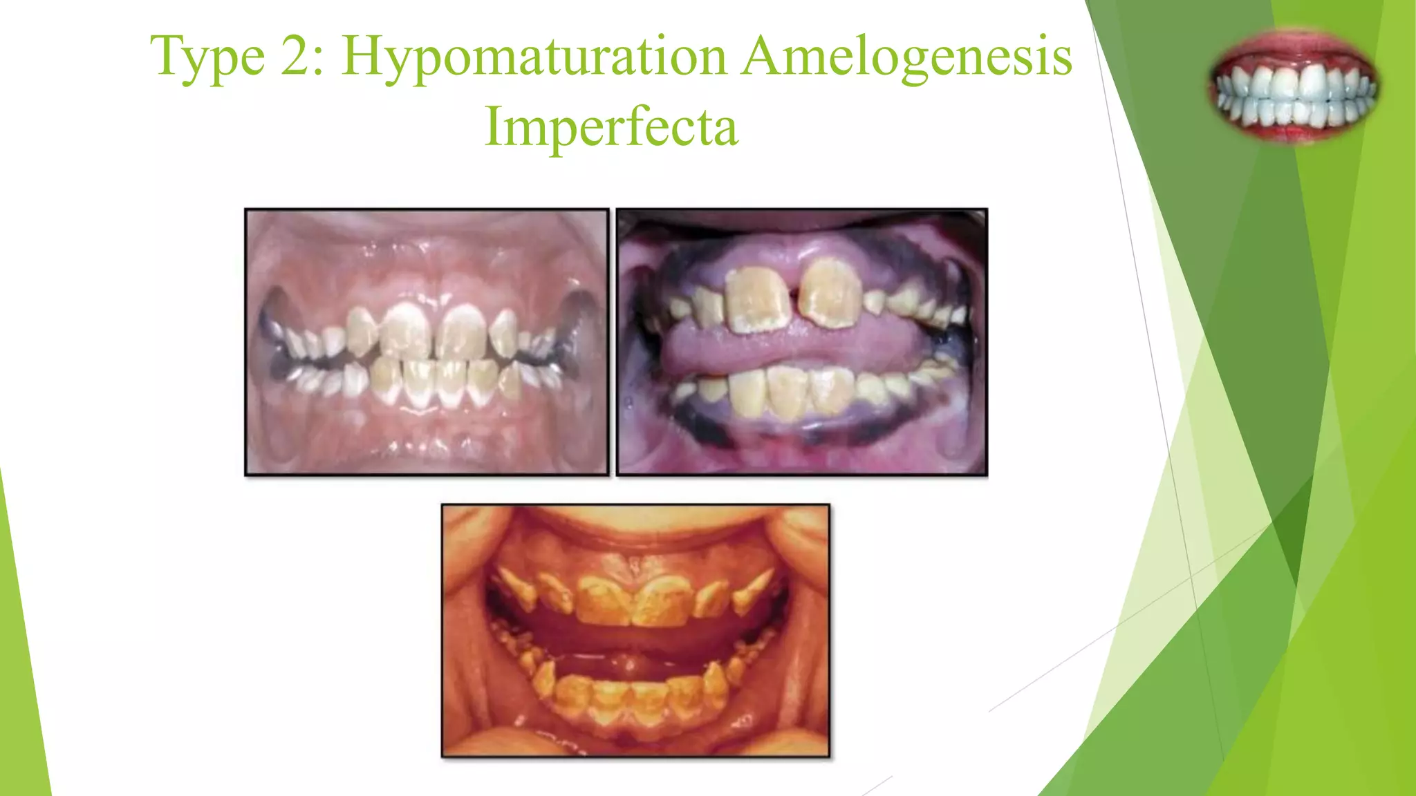 Amelogenesis imperfecta | PPTX