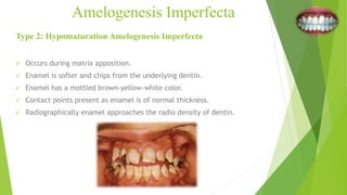 Amelogenesis imperfecta | PPTX