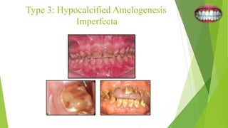 Amelogenesis imperfecta | PPTX