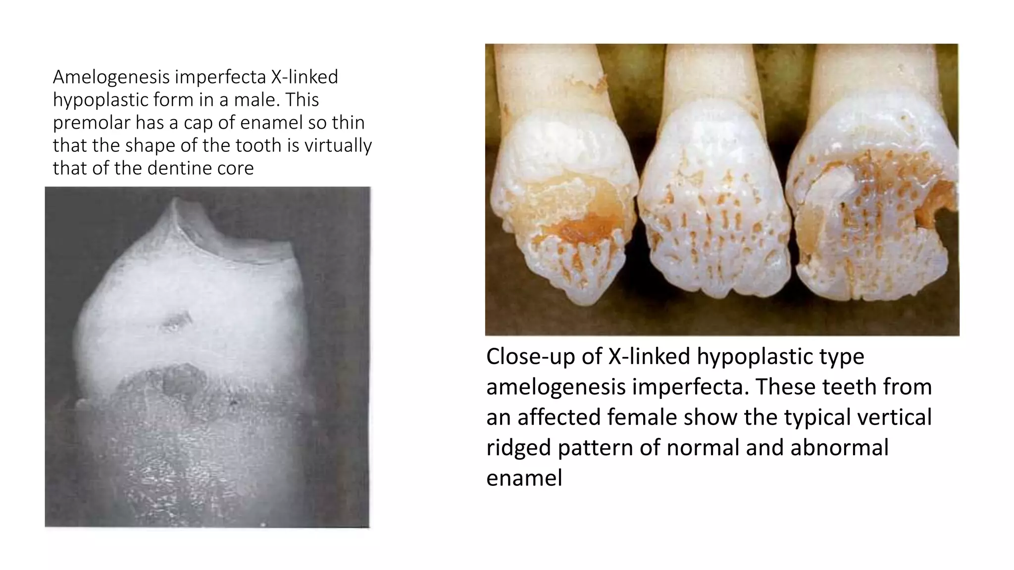 Amelogenesis imperfecta | PPTX