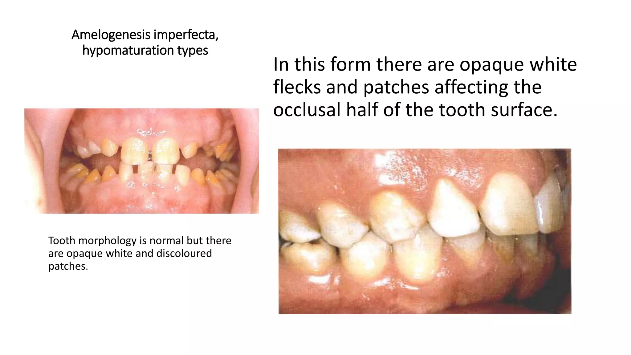 Amelogenesis imperfecta | PPTX