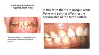 Amelogenesis imperfecta | PPTX