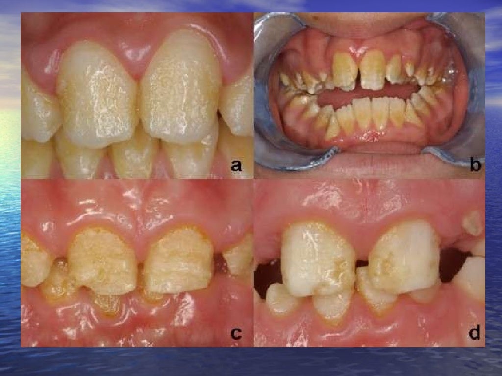 Amelogenesis Imperfecta
