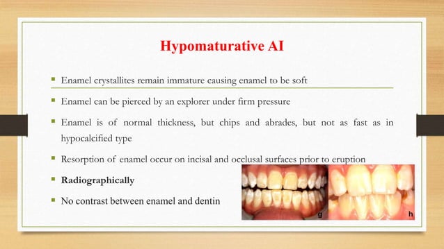 Amelogenesis imperfecta (AI) | PPTX