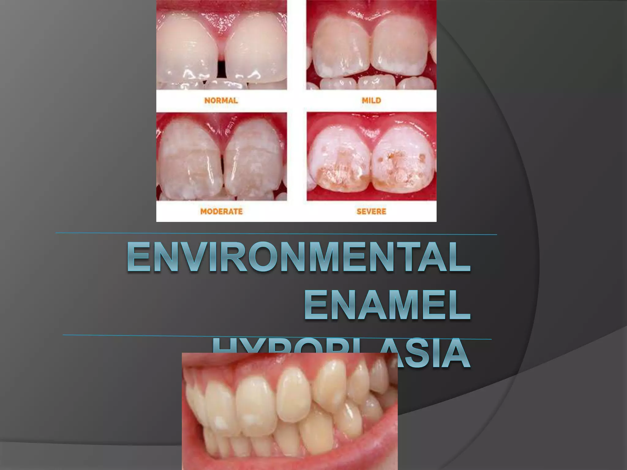 Amelogenesis Imperfecta & Environmental Enamel Hypoplasia | PPTX