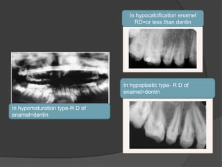 Enamel Hypocalcification Vs Enamel Hypoplasia