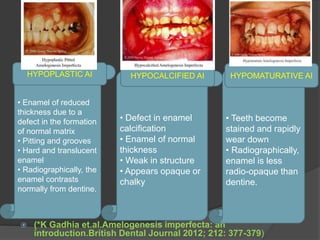 Enamel Hypocalcification Vs Enamel Hypoplasia