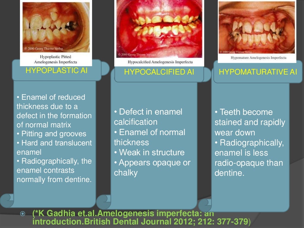 Amelogenesis Imperfecta & Environmental Enamel Hypoplasia