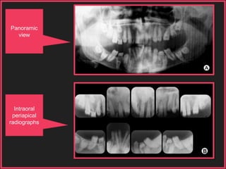 Amelogenesis Imperfecta Radiograph