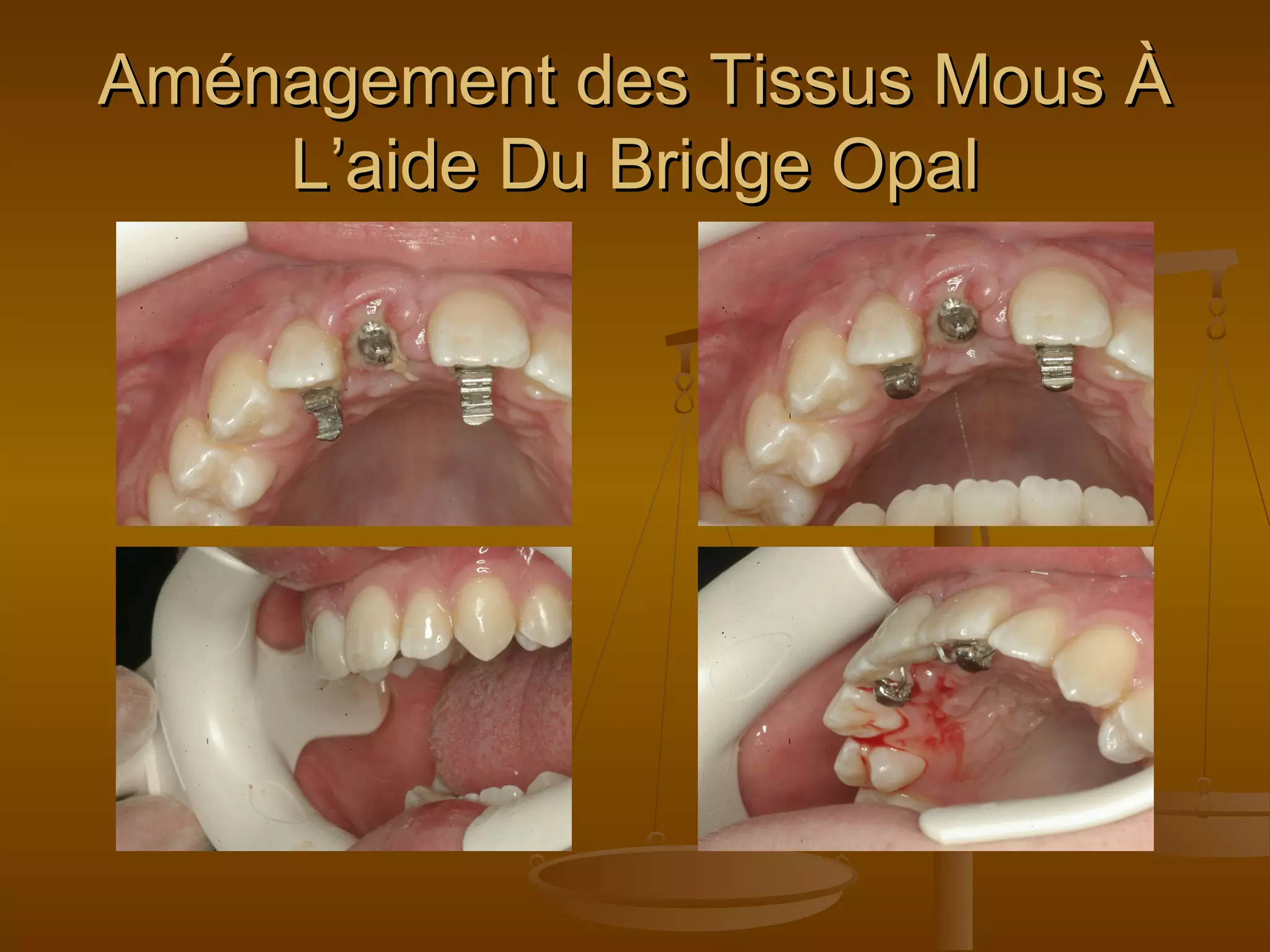 Gingival Improvement through Removable Bridge | PPT