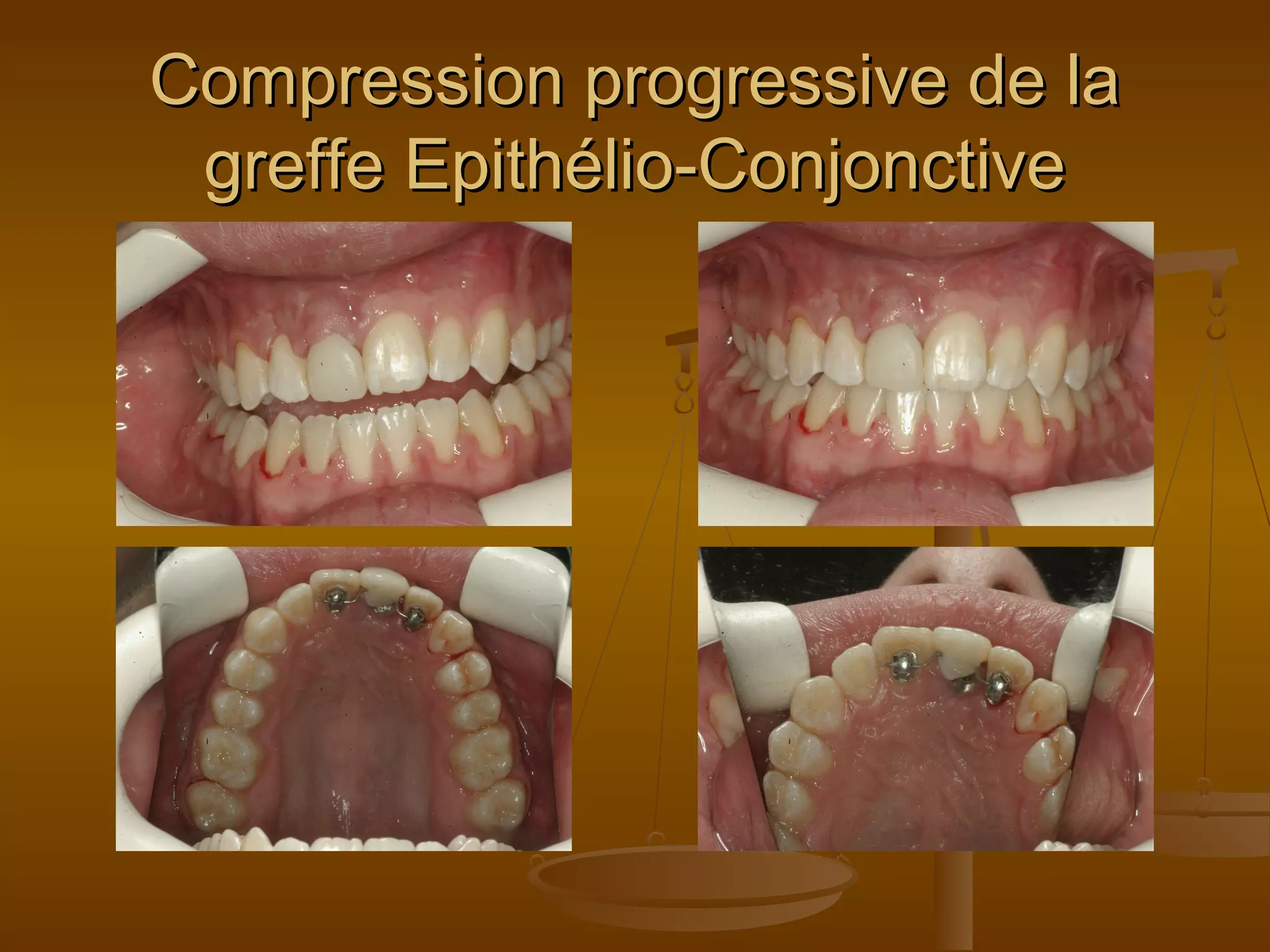 Gingival Improvement through Removable Bridge | PPT