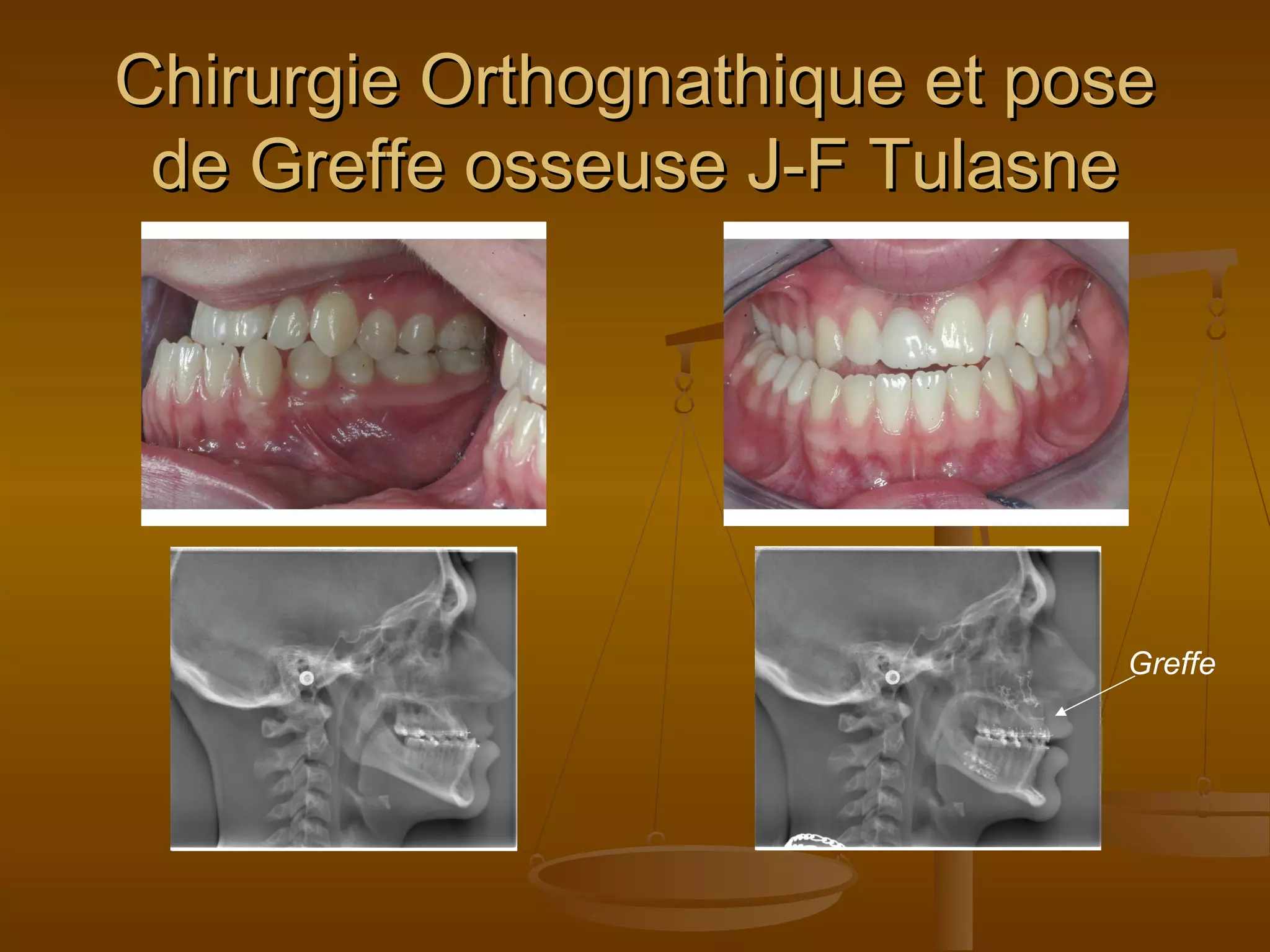 Gingival Improvement through Removable Bridge | PPT