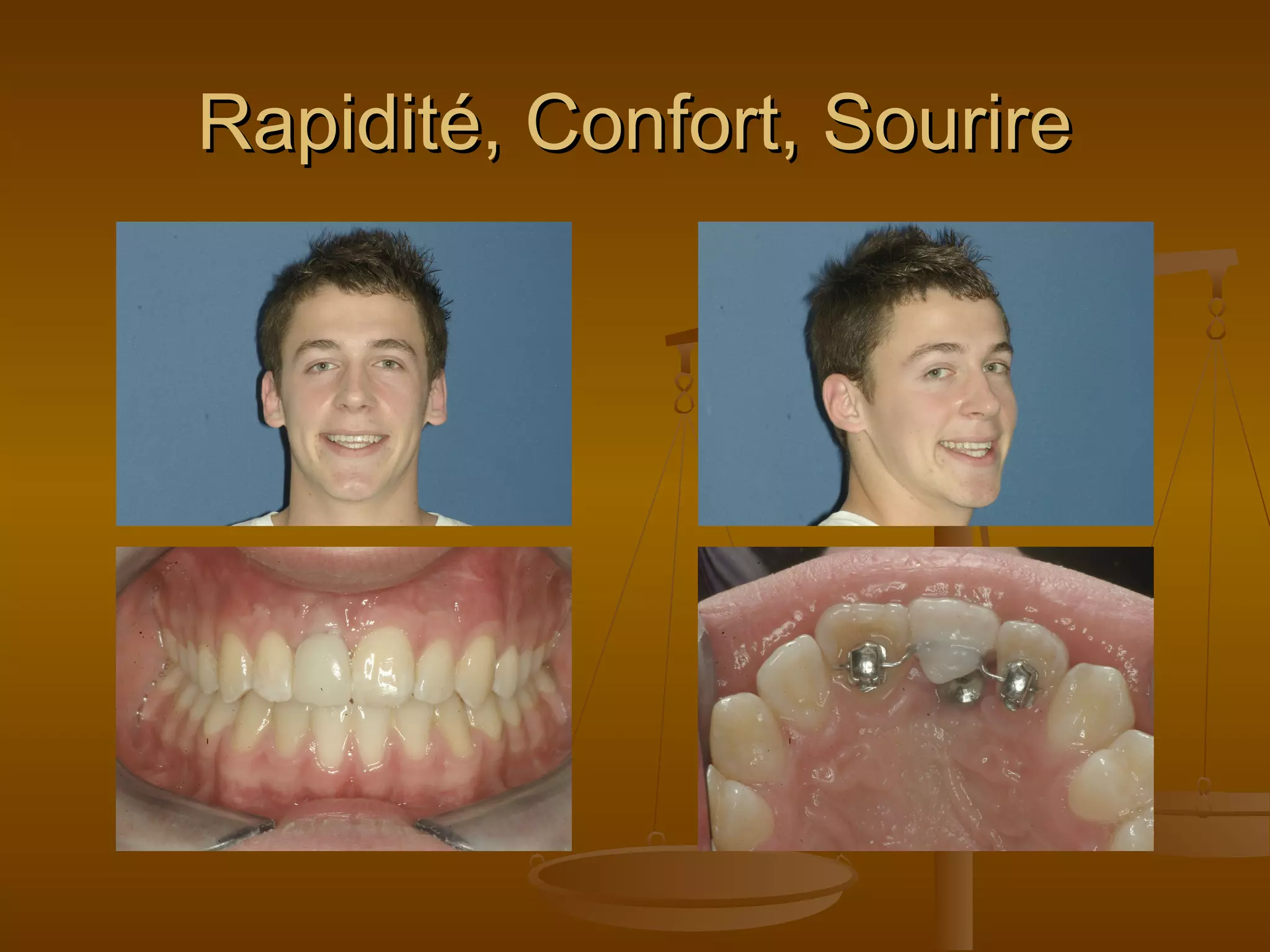 Gingival Improvement through Removable Bridge | PPT
