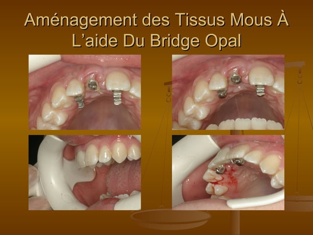 Gingival Improvement through Removable Bridge | PPT