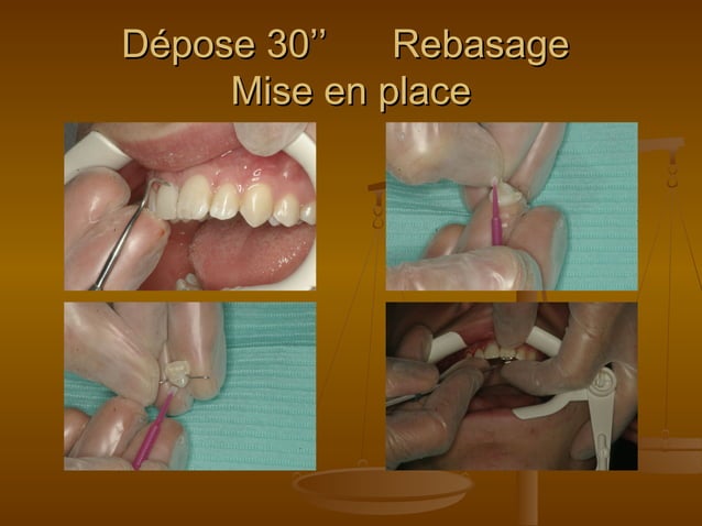 Gingival Improvement through Removable Bridge | PPT
