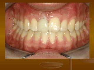 Gingival Improvement through Removable Bridge | PPT