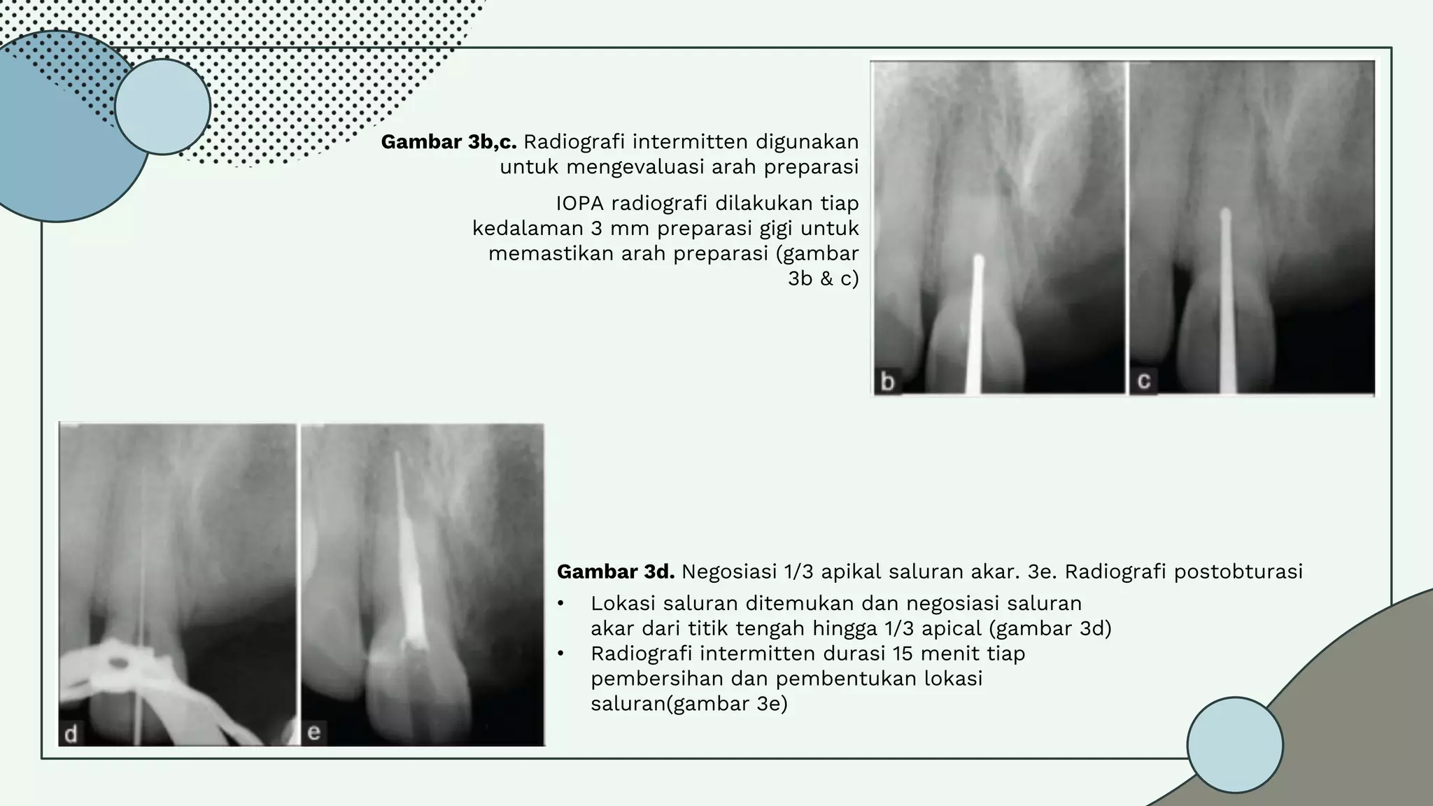 Amenina rezkia perawatan endodontik terpandu obliterasi atau saluran akar terkalsifikasi | PPTX