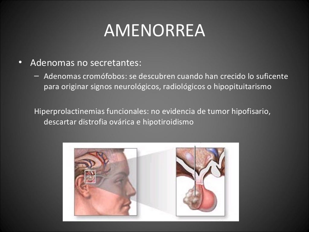 Amenorrea