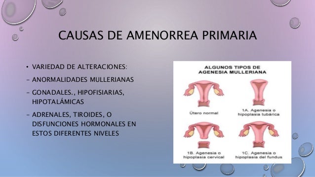 Amenorrea