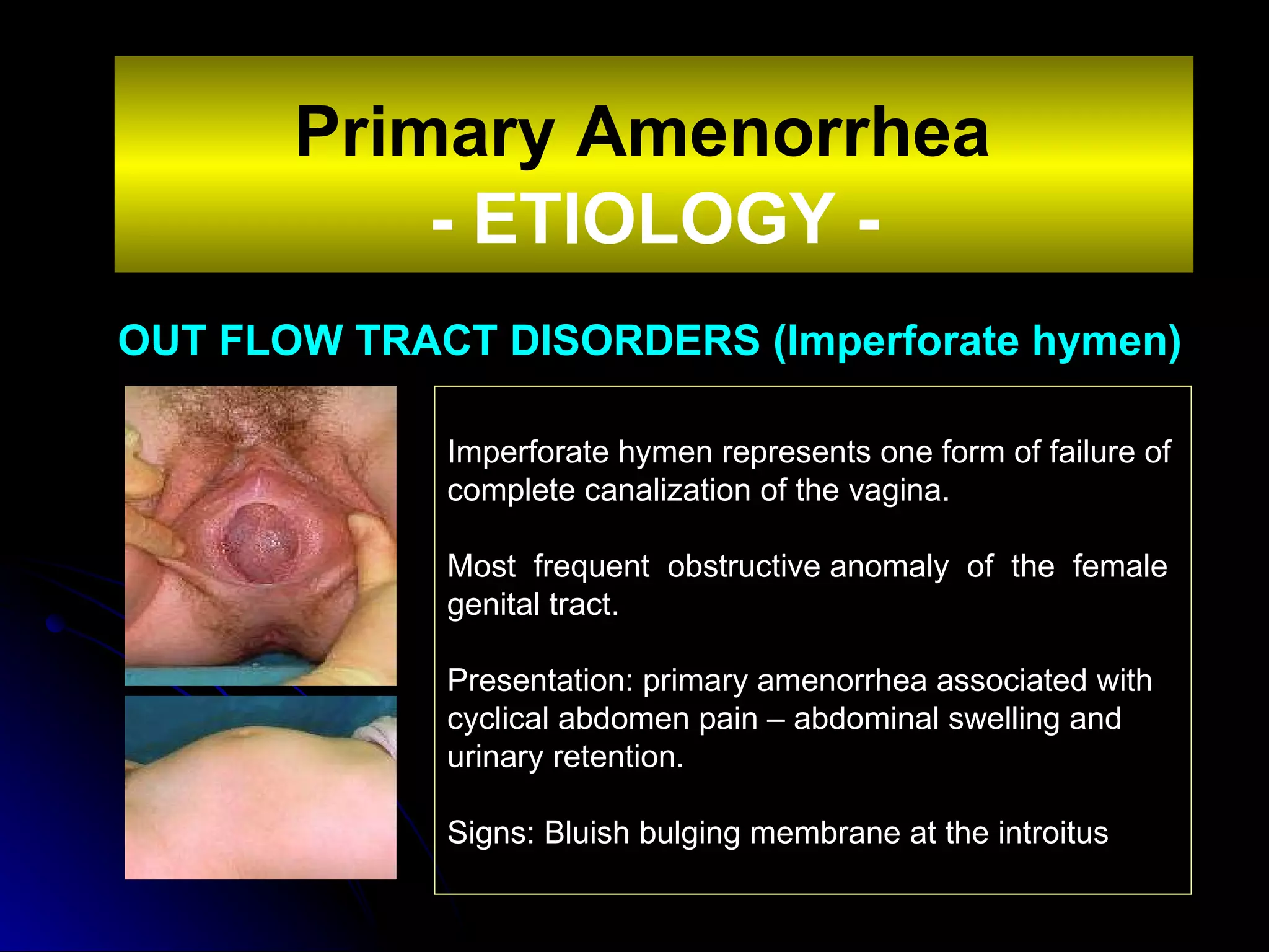 Amenorrhea | PPT