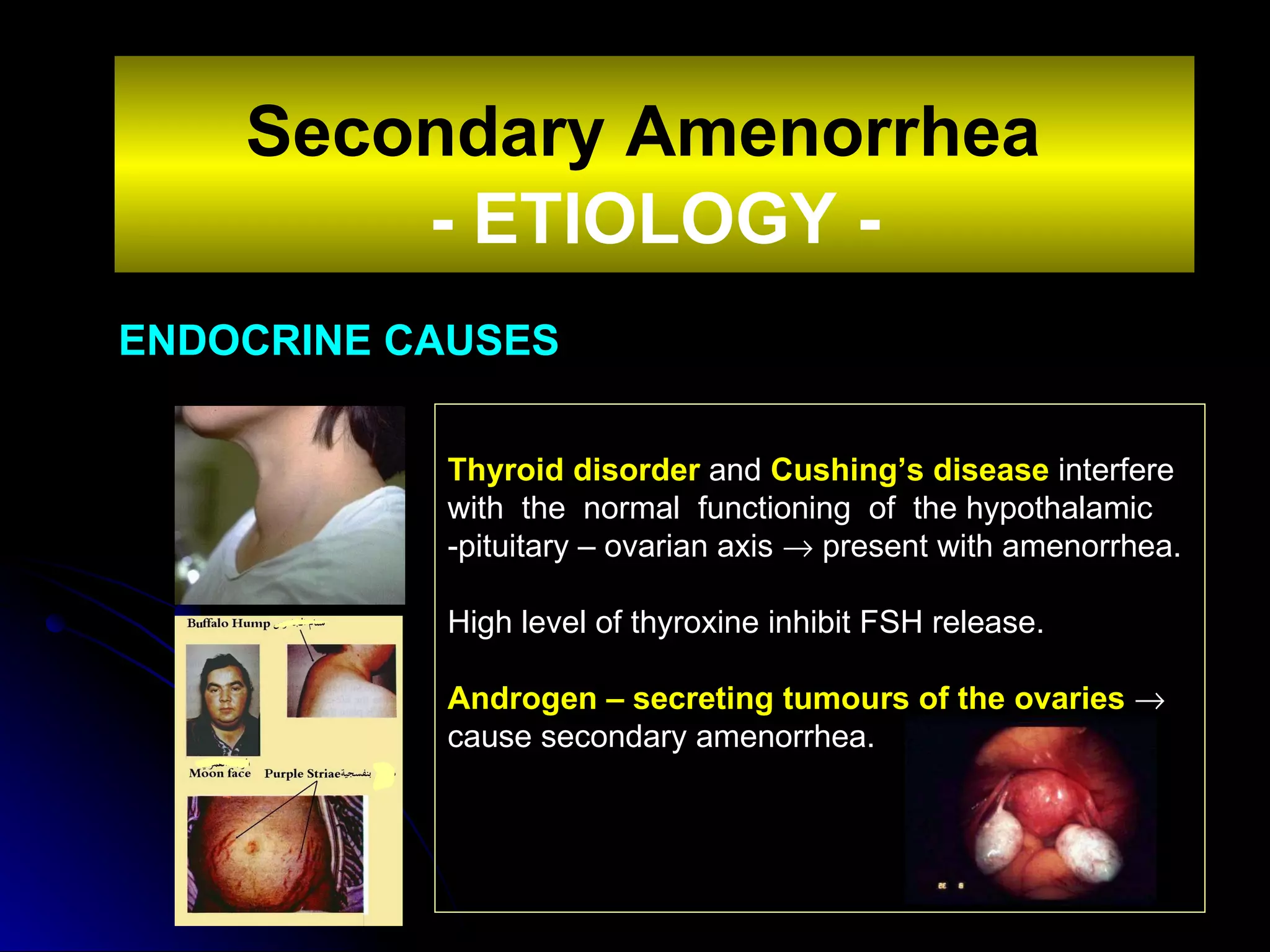 Amenorrhea | PPT