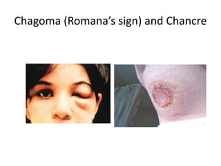 AMERICAN TRYPANOSOMIASIS.pptx | Digestive Disorders | Diseases and ...