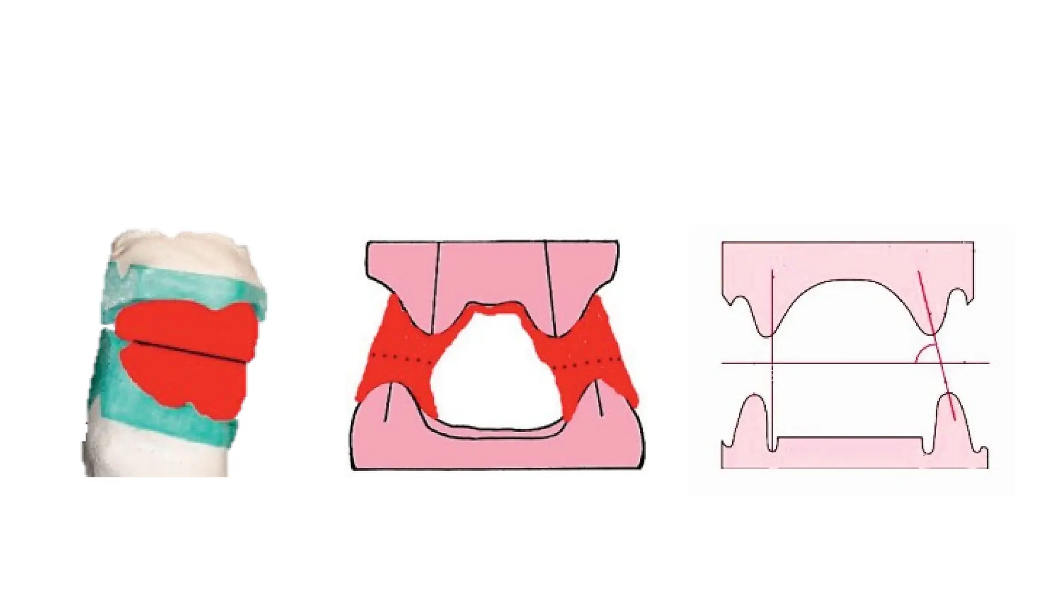 A METHOD OF CROSSBITE SETTING in class 3.pptx